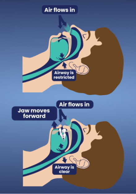 Snoreeze Oral Device | Snoreeze Snoring Relief